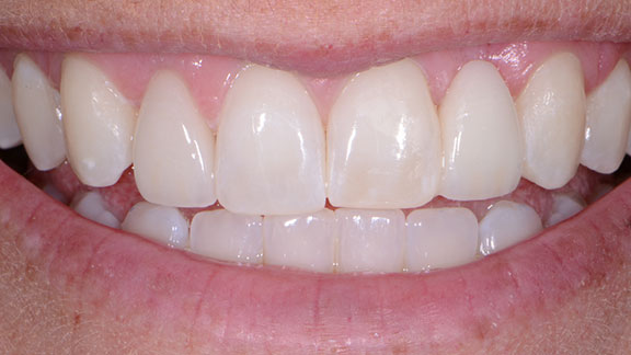 Smile Gallery | Dental Treatment Before and After Photos