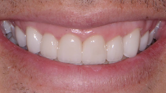 Smile Gallery | Dental Treatment Before and After Photos