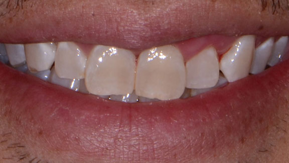 Smile Gallery | Dental Treatment Before and After Photos