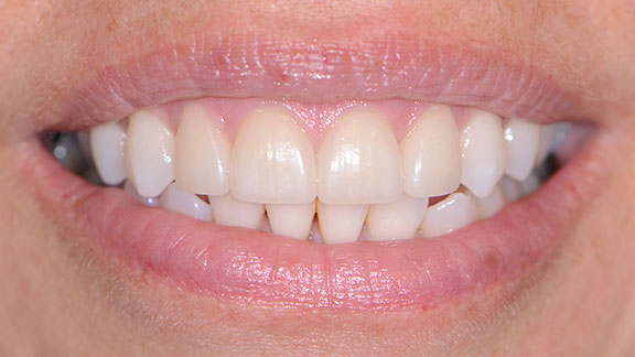 Smile Gallery | Dental Treatment Before and After Photos