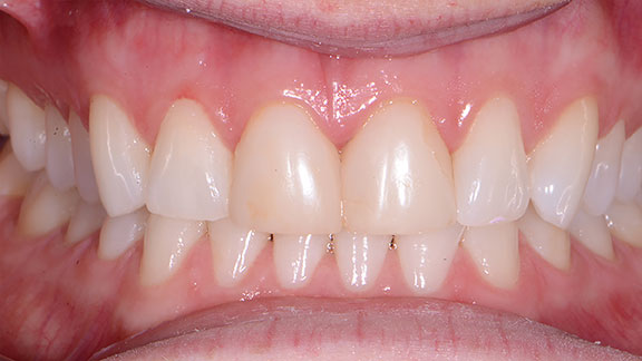 Smile Gallery | Dental Treatment Before and After Photos